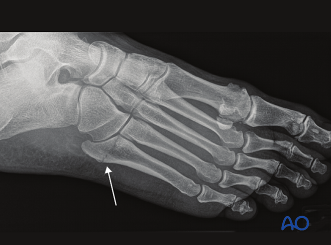 Proximal articular fractures of the 5th metatarsal (Jones fracture)