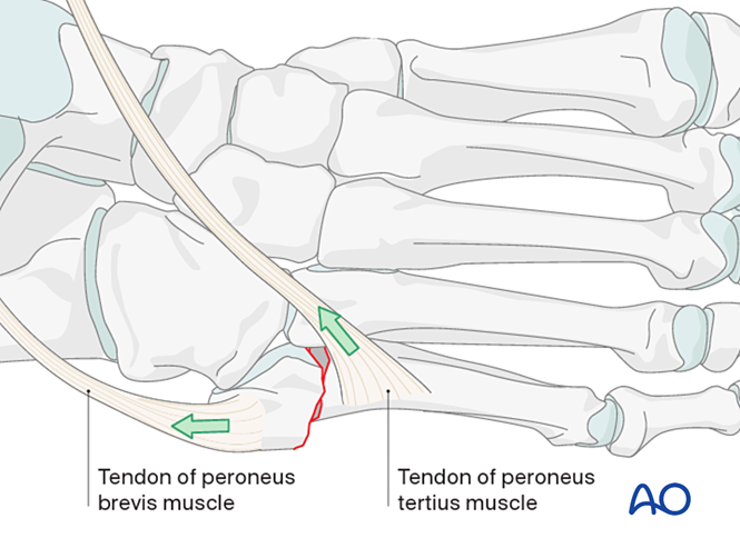 Proximal articular fractures of the 5th metatarsal (Jones fracture)