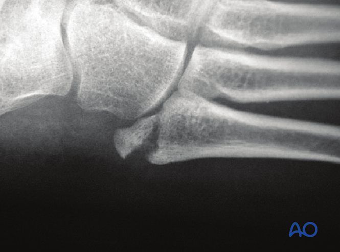 Proximal avulsion fractures of the 5th metatarsal (pseudo-Jones)
