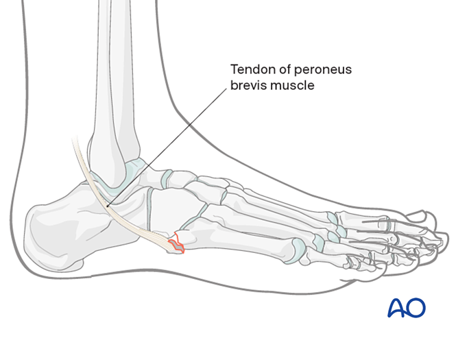 Proximal avulsion fractures of the 5th metatarsal (pseudo-Jones)