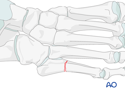 Proximal extraarticular fractures of the 5th metatarsal (march fracture)