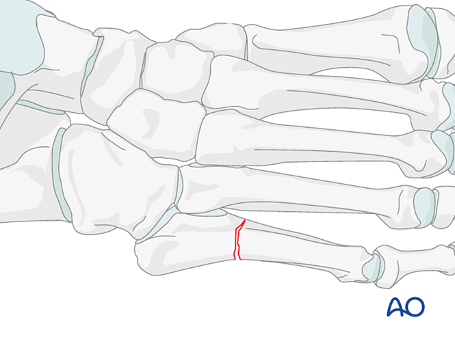 Proximal extraarticular fractures of the 5th metatarsal (march fracture)