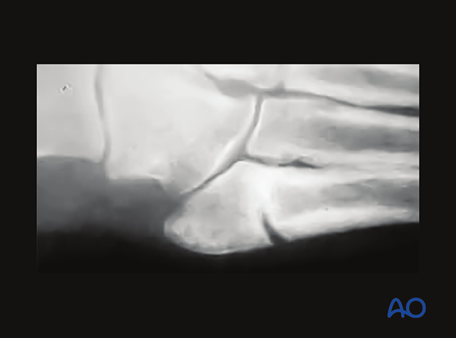 Proximal extraarticular fractures of the 5th metatarsal (march fracture)