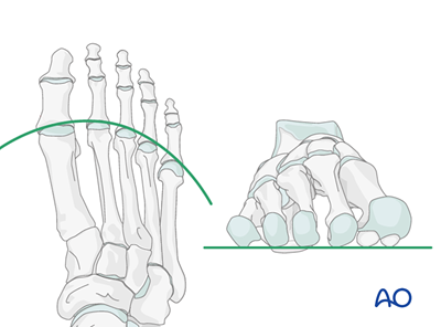 Excision arthroplasty for Distal fractures of the 5th metatarsal