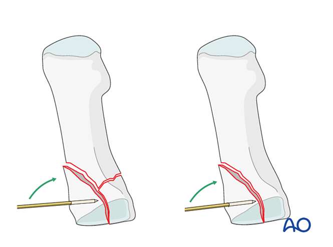Lag screw fixation of proximal articular fractures of the 1st-4th ...