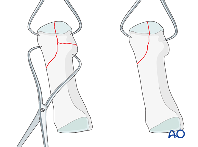 Lag screw fixation for Distal articular fractures of the 1st to 4th ...