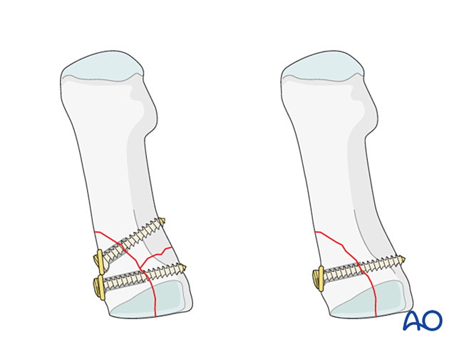 Lag screw fixation of proximal articular fractures of the 1st-4th ...
