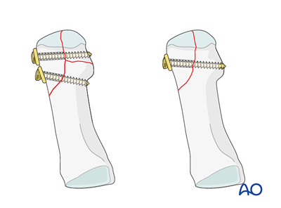 Lag screw fixation for Distal articular fractures of the 1st to 4th ...