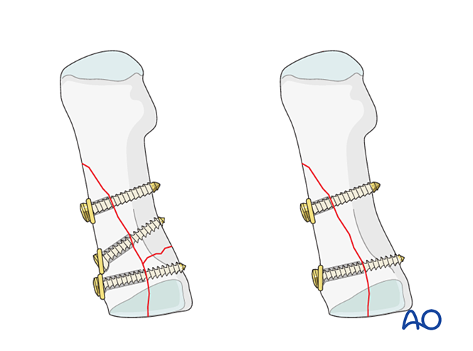 Lag screw fixation for Proximal articular fractures of the 1st to 4th ...
