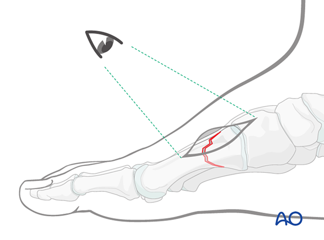 Nonlocking plate fixation with/without lag screws of proximal articular ...