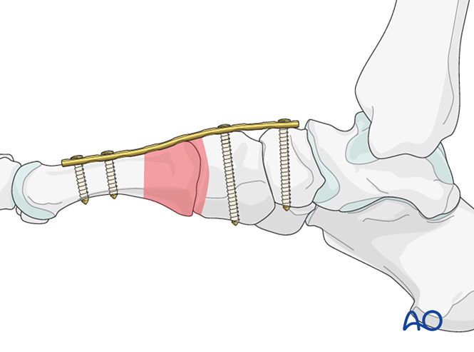 Dorsal spanning plate for Proximal articular fractures of the 1st to ...