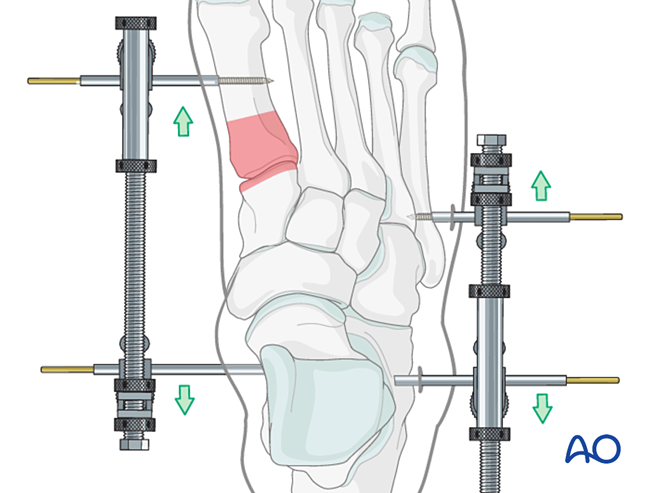 Dorsal spanning plate for Proximal articular fractures of the 1st to ...