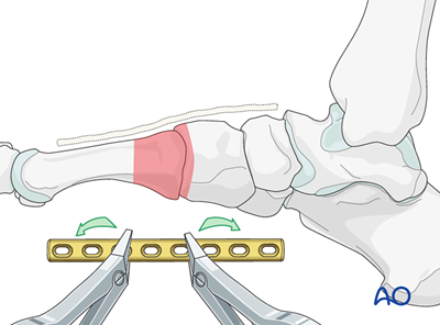 Dorsal spanning plate for Proximal articular fractures of the 1st to ...