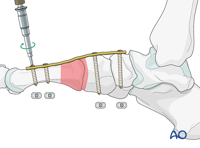 Dorsal spanning plate for Proximal articular fractures of the 1st to ...