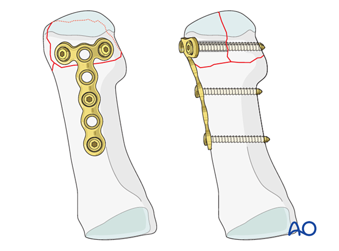 Nonlocking plate with/without lag screws for Distal articular fractures ...