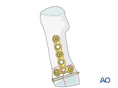 Nonlocking plate with/without lag screws for Proximal articular ...