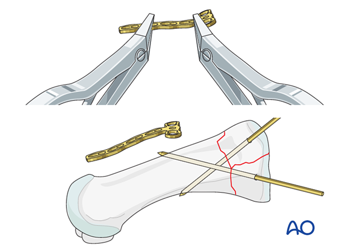 Nonlocking plate fixation with/without lag screws of proximal articular ...