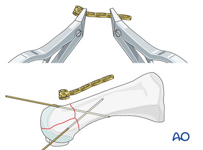 Locking plate with/without lag screw for Distal articular fractures of ...