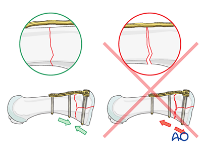 Nonlocking plate with/without lag screws for Proximal articular ...