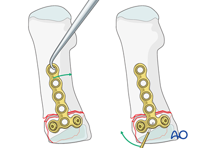 Nonlocking plate fixation with/without lag screws of proximal articular ...