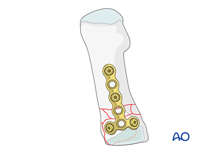 Nonlocking plate with/without lag screws for Proximal articular ...