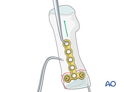 Nonlocking plate with/without lag screws for Proximal articular ...