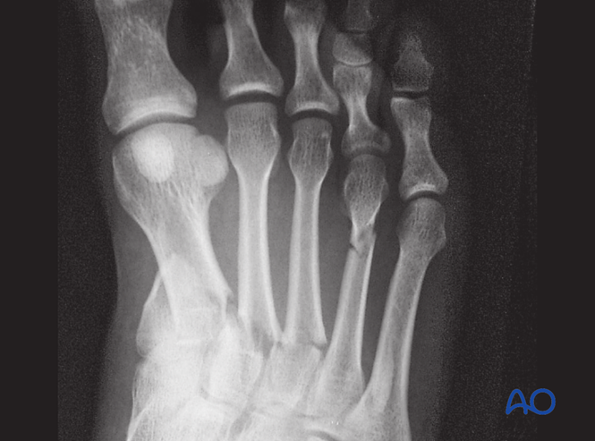 ORIF for Crush injuries