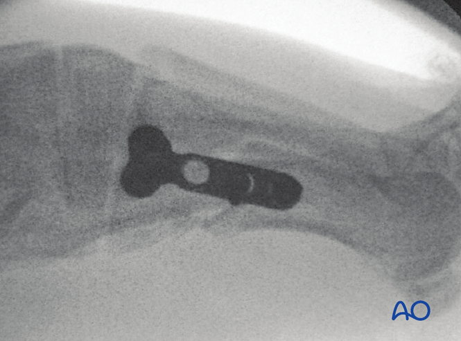 ORIF for Crush injuries