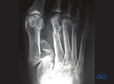 Nonlocking plate with/without lag screws for Proximal articular ...