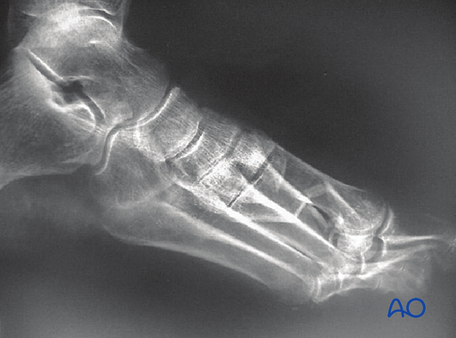 Nonlocking plate with/without lag screws for Proximal articular ...