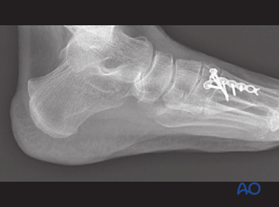 Nonlocking plate with/without lag screws for Proximal articular ...