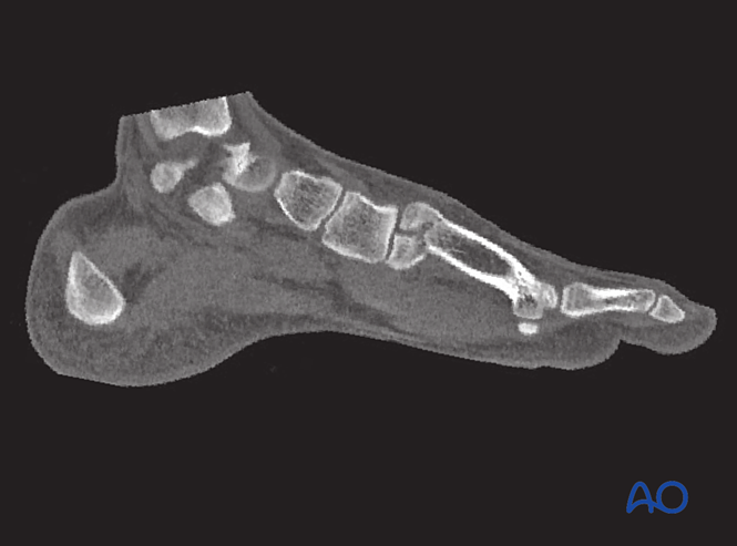 Nonlocking plate with/without lag screws for Proximal articular ...