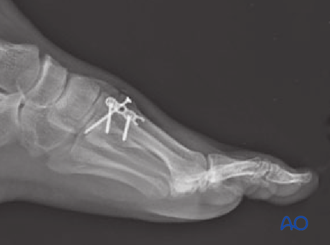 Nonlocking plate with/without lag screws for Proximal articular ...