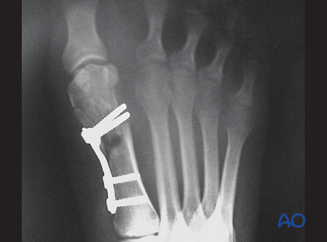 Bridge plate fixation for Multifragmentary diaphyseal and proximal ...