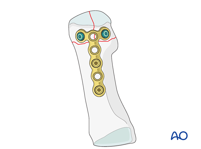 Locking plate with/without lag screw for Distal articular fractures of ...