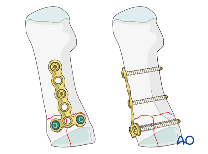 Locking plate fixation with/without lag screw of proximal articular ...