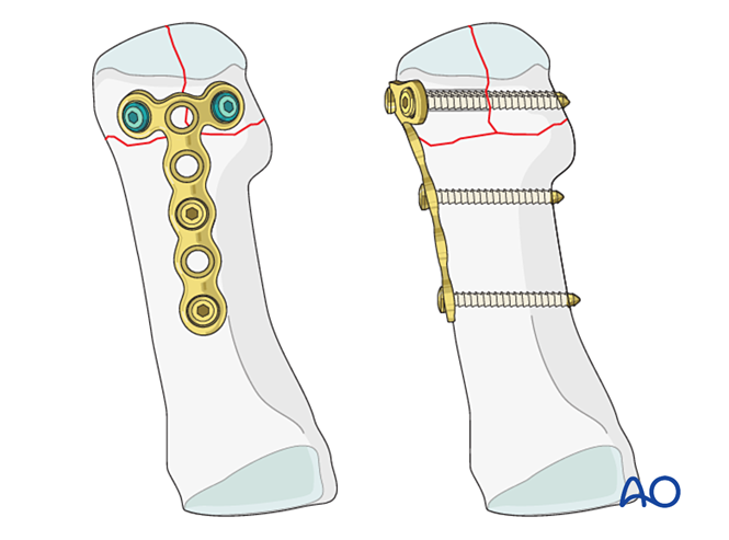 Locking plate with/without lag screw for Distal articular fractures of ...