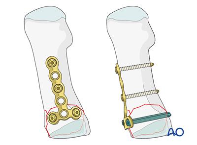 Locking plate fixation with/without lag screw of proximal articular ...