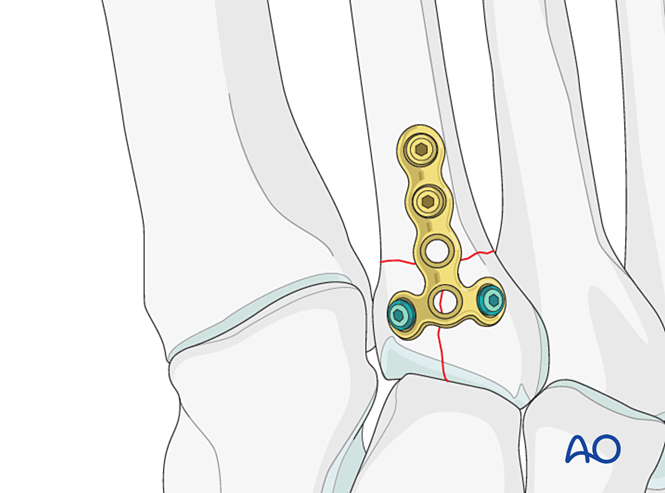 Locking plate fixation with/without lag screw of proximal articular ...