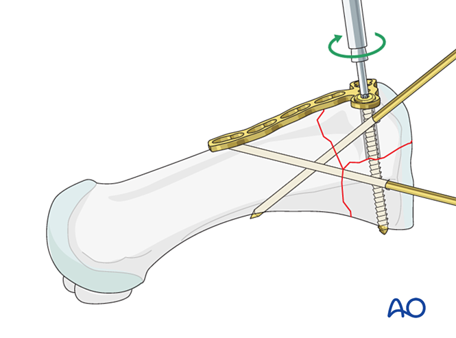 Locking plate fixation with/without lag screw of proximal articular ...