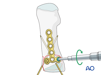 Locking plate fixation with/without lag screw of proximal articular ...