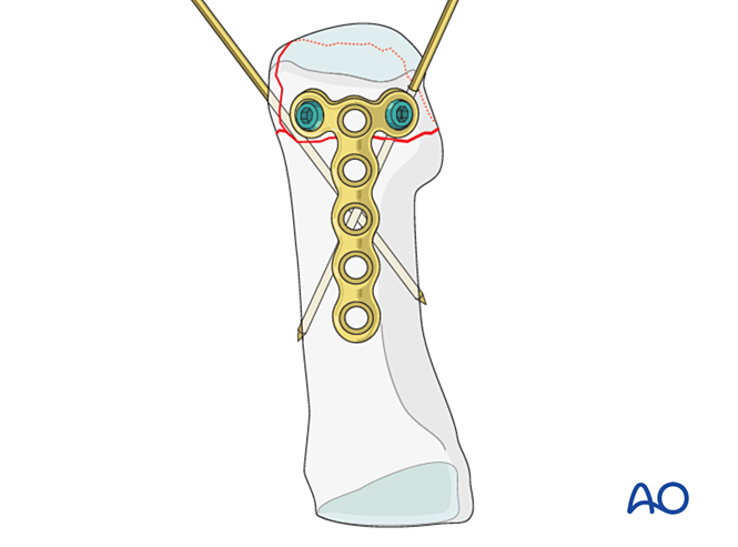 Locking plate with/without lag screw for Distal articular fractures of ...