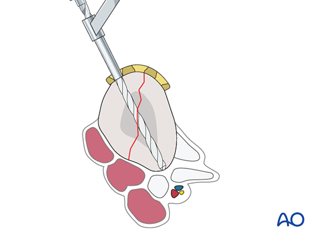 Locking plate fixation with/without lag screw of proximal articular ...