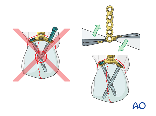 Locking plate with/without lag screw for Distal articular fractures of ...