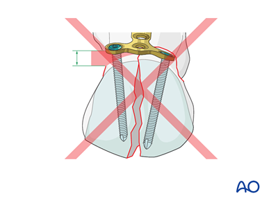 Locking plate fixation with/without lag screw of proximal articular ...