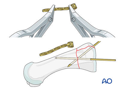 Locking plate with/without lag screw for Proximal articular fractures ...