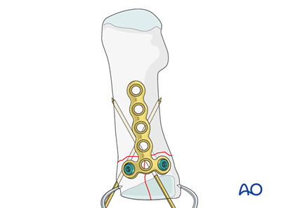 Locking plate fixation with/without lag screw of proximal articular ...