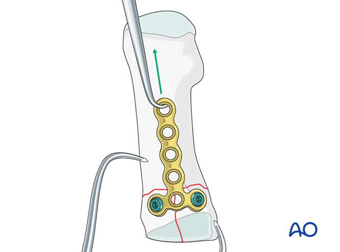Locking plate fixation with/without lag screw of proximal articular ...