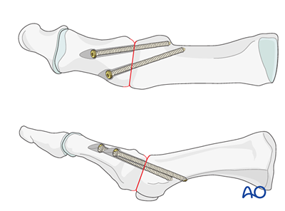 Arthrodesis of 1st MTP joint for Distal articular fractures of the 1st ...