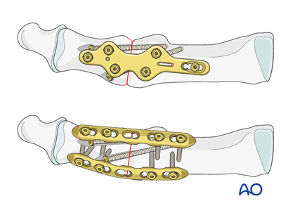 Arthrodesis of 1st MTP joint for Distal articular fractures of the 1st ...